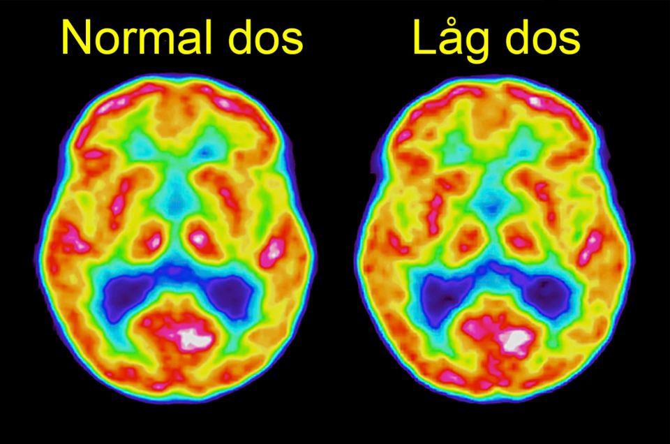 Stråldosen kan halveras vid PET-undersökning av patienter med misstänkt ...